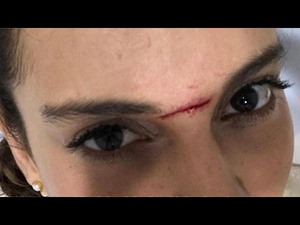 Kangana Ranaut Suffers A Deep Cut On Her Forehead During A Sword ...